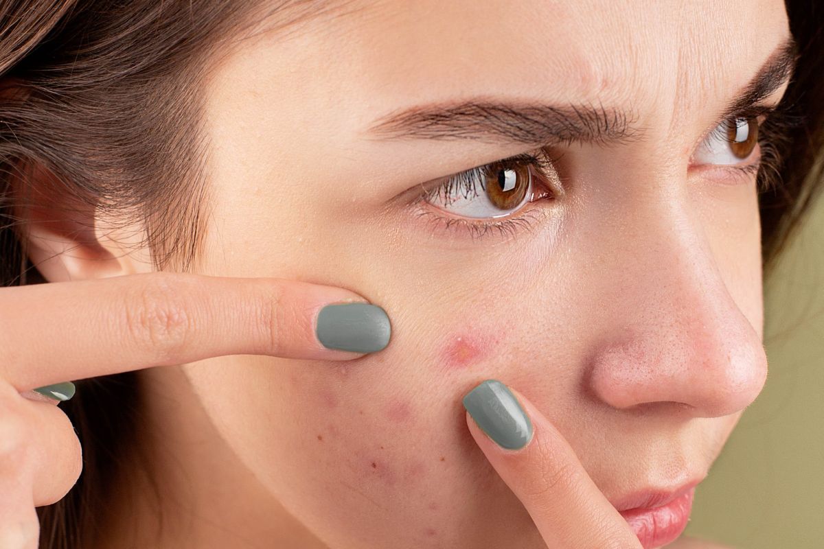 Can Collagen Cause Acne? Here's What You Need to Know - Charas Scientific